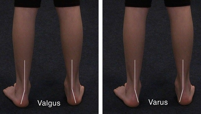 Valgus and varus deformity of the foot: what is it, what is the difference, causes